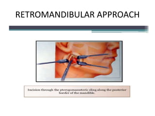 Submandibular and retromandibular approach | PPTX