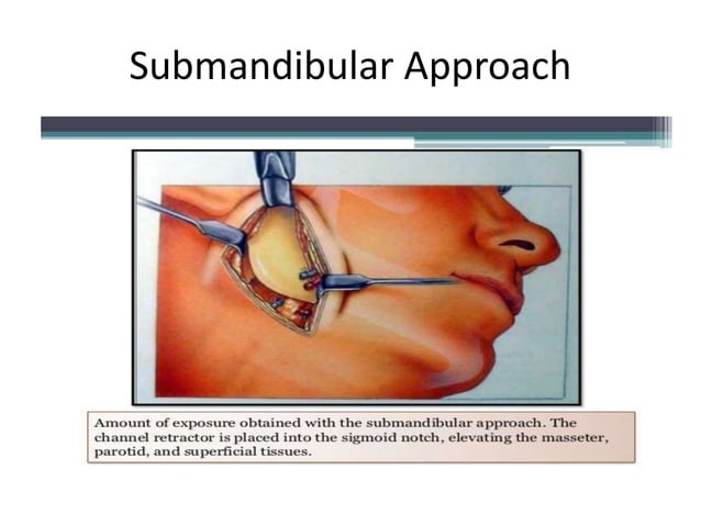Submandibular and retromandibular approach