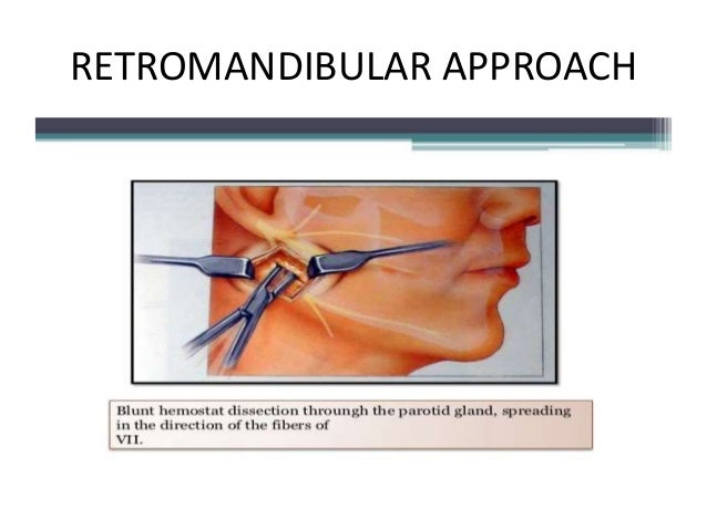 Submandibular and retromandibular approach