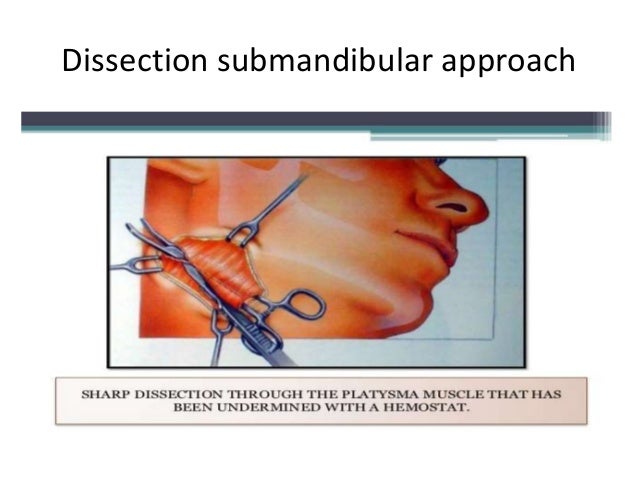 Submandibular and retromandibular approach