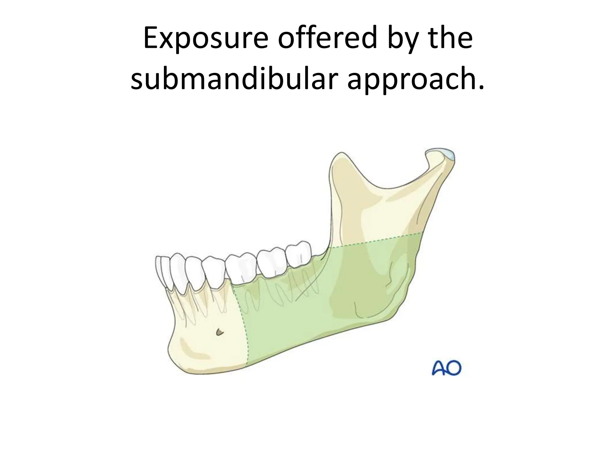 SUBMANDIBULAR APPROACH PPT for mandibular fractures.pptx