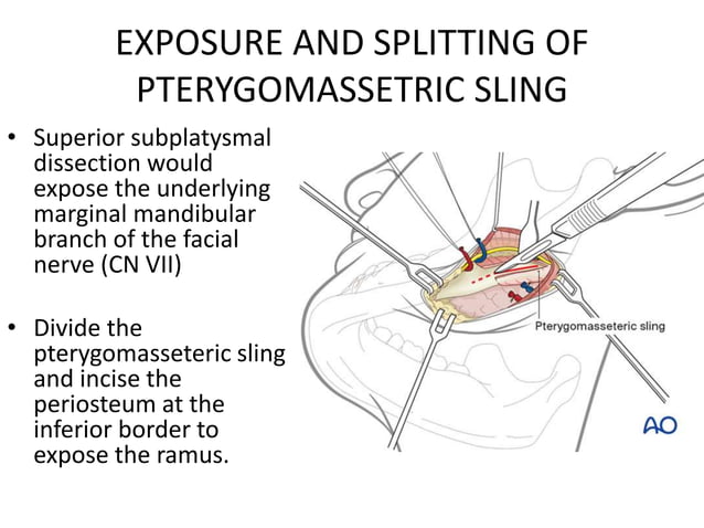 SUBMANDIBULAR APPROACH PPT for mandibular fractures.pptx | Death ...