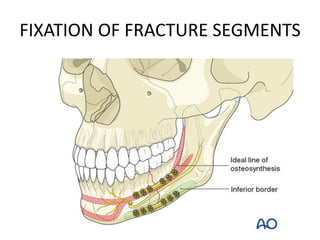 SUBMANDIBULAR APPROACH PPT for mandibular fractures.pptx