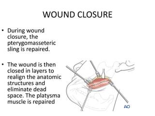SUBMANDIBULAR APPROACH PPT for mandibular fractures.pptx