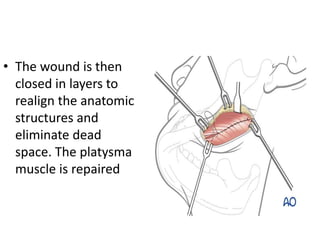 SUBMANDIBULAR APPROACH PPT for mandibular fractures.pptx