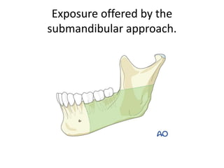 SUBMANDIBULAR APPROACH PPT for mandibular fractures.pptx