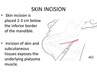 SUBMANDIBULAR APPROACH PPT for mandibular fractures.pptx