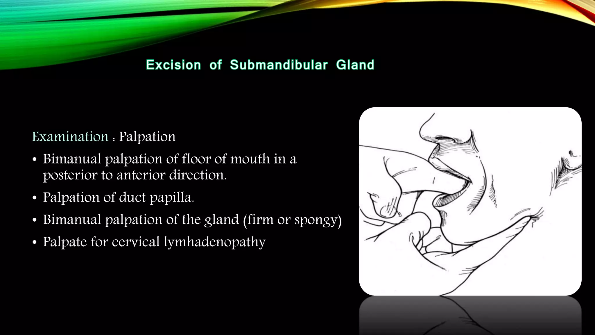 Submandibular gland excision | PPTX