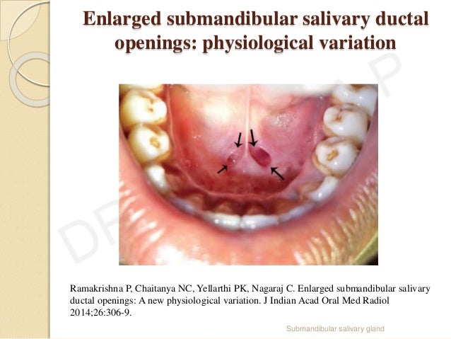 Submandibular salivary gland dr chithra