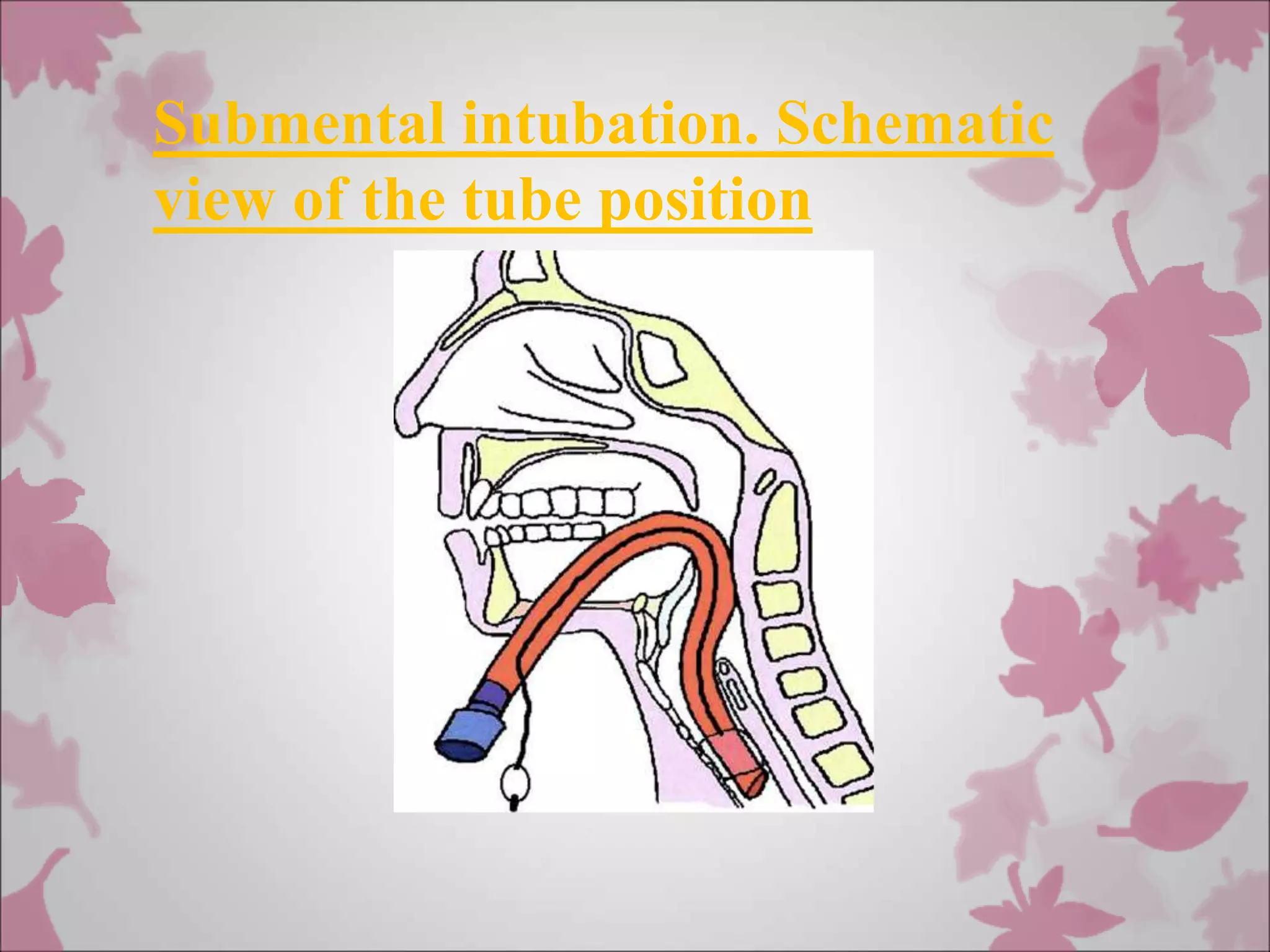 submental intubation.ppt