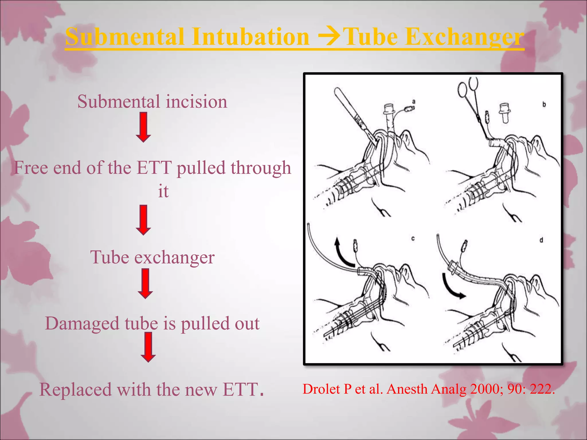 submental intubation.ppt