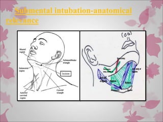 submental intubation.ppt