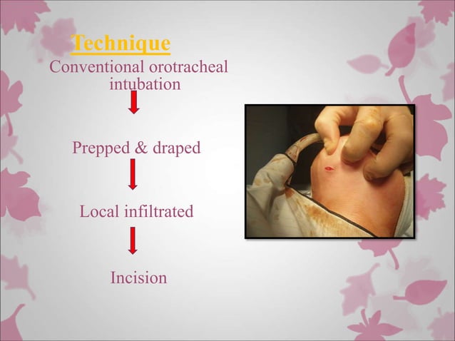 submental intubation.ppt | Ear, Nose and Throat Conditions | Diseases ...