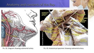 Submental island flap | PPT