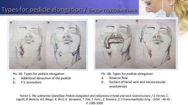 Submental island flap