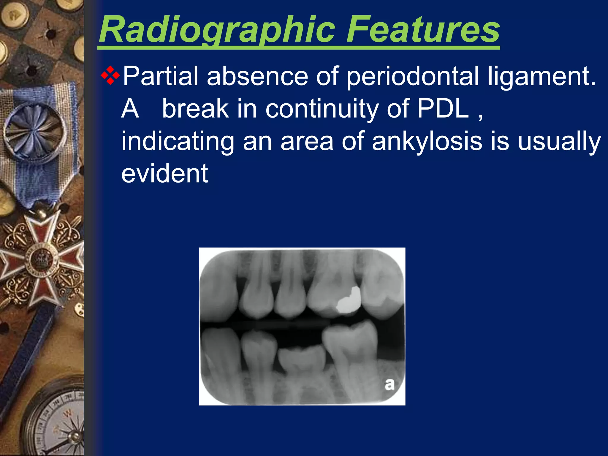 ankylosis of teeth | PPTX
