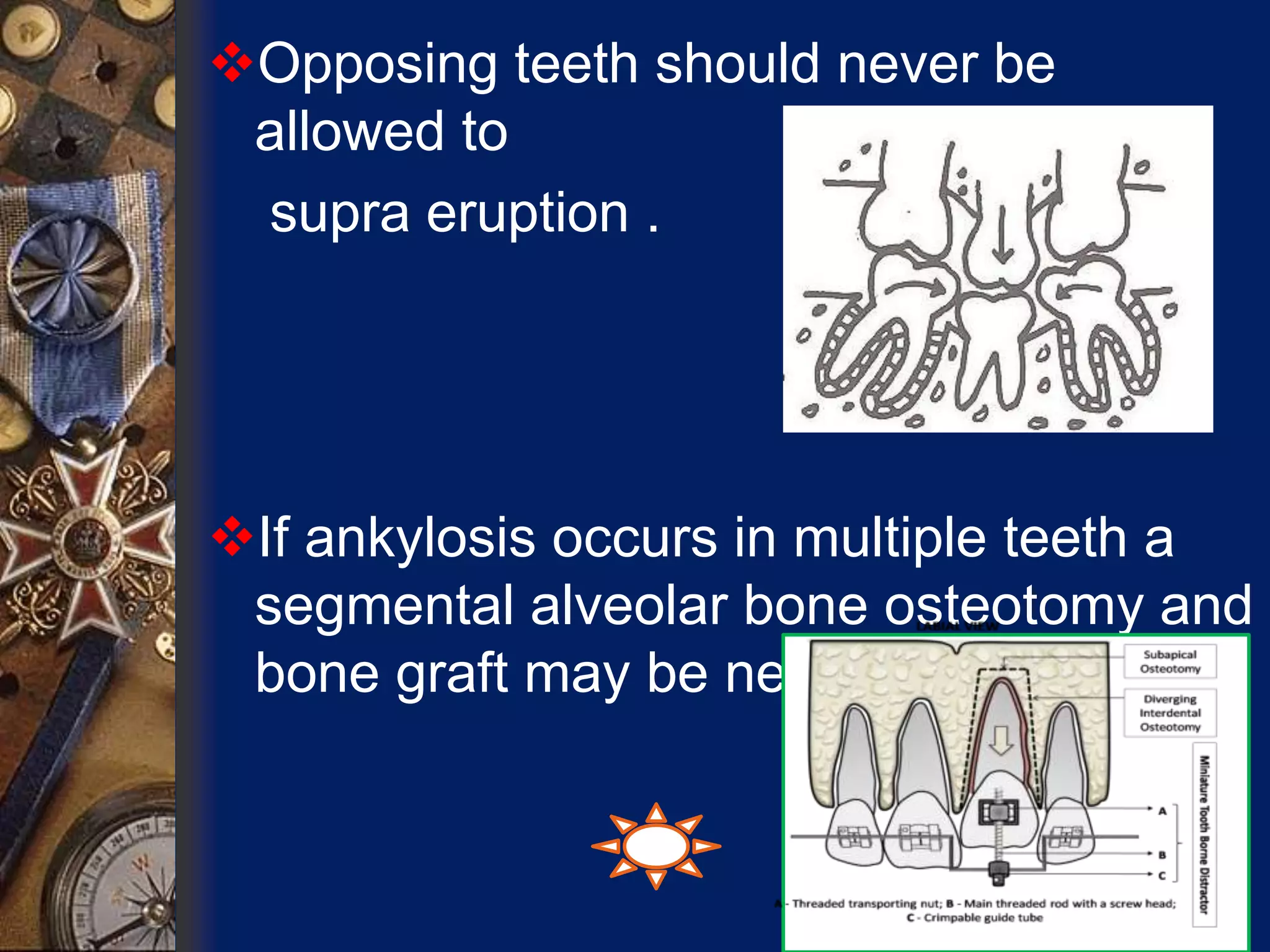 ankylosis of teeth | PPTX