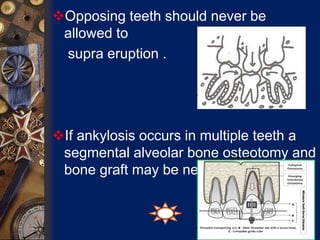 ankylosis of teeth | PPTX