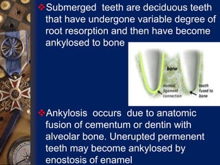 ankylosis of teeth | PPTX
