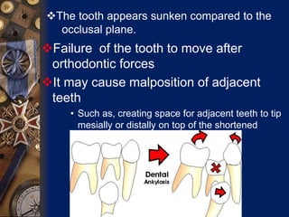 ankylosis of teeth | PPTX