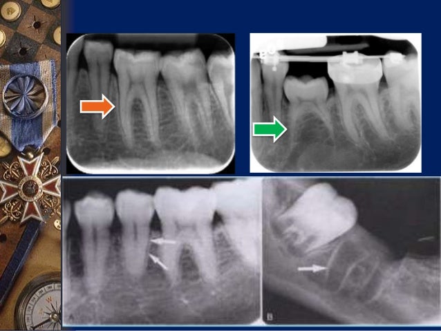 Ankylosis Of Teeth
