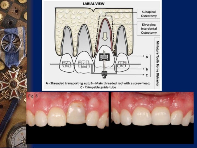 ankylosis of teeth