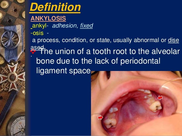 ankylosis of teeth