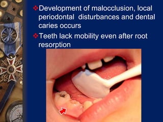 Submerged tooth | PPTX