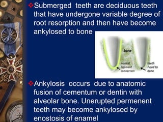 Submerged tooth | PPT