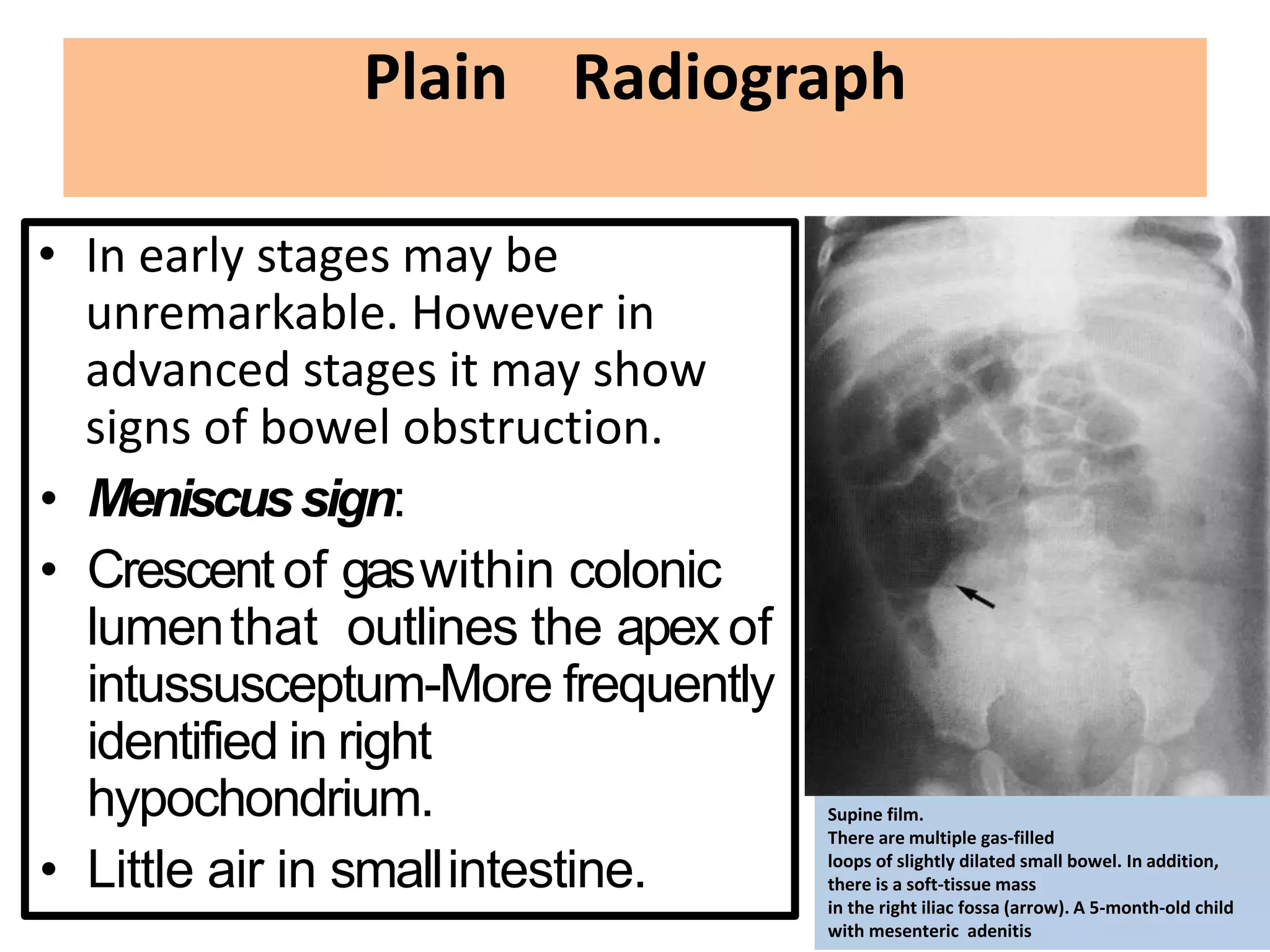 Intussusception in Adults-Submucosal Lipoma at Transverse colon-A rare ...