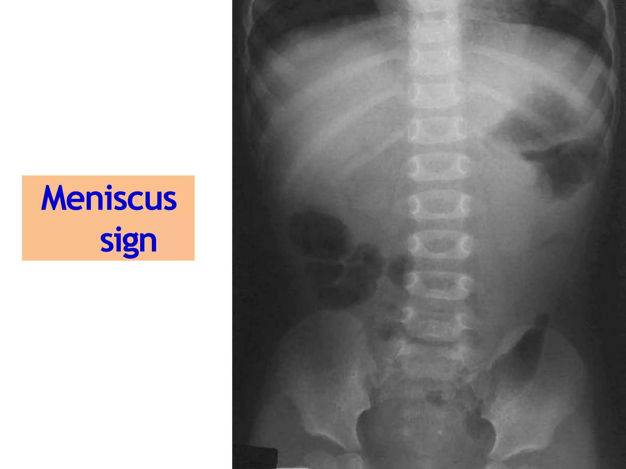 Intussusception in Adults-Submucosal Lipoma at Transverse colon-A rare ...