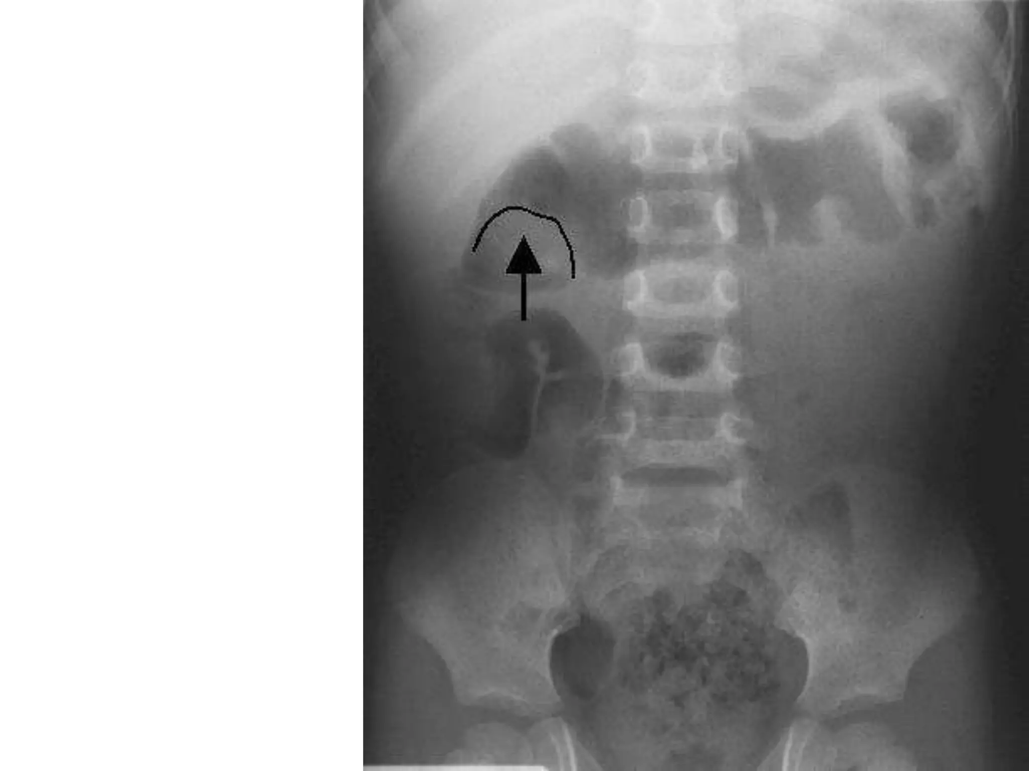 Intussusception in Adults-Submucosal Lipoma at Transverse colon-A rare ...