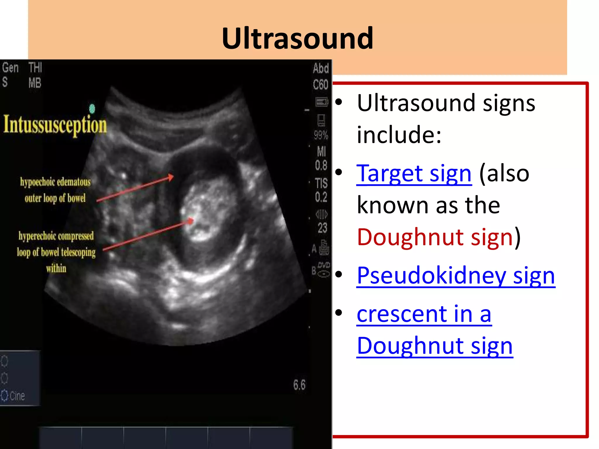 Intussusception In Adults Submucosal Lipoma At Transverse Colon A Rare