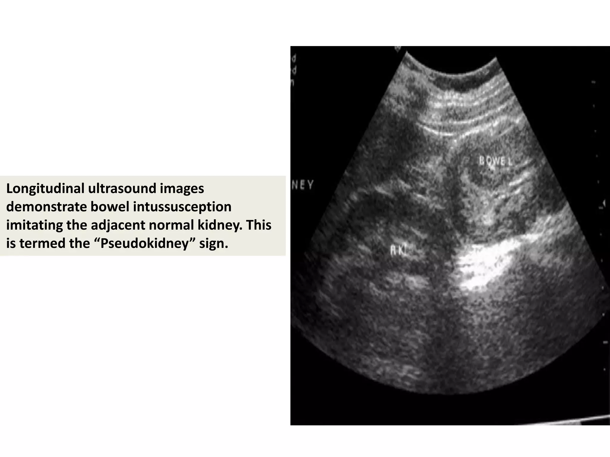 Intussusception in Adults-Submucosal Lipoma at Transverse colon-A rare ...