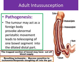 Intussusception in Adults-Submucosal Lipoma at Transverse colon-A rare ...