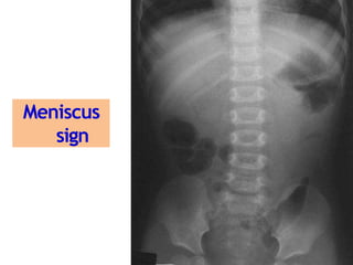 Intussusception in Adults-Submucosal Lipoma at Transverse colon-A rare ...