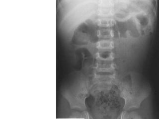 Intussusception in Adults-Submucosal Lipoma at Transverse colon-A rare ...