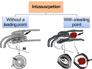 Intussusception in Adults-Submucosal Lipoma at Transverse colon-A rare ...