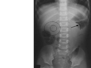 Intussusception Claw Sign