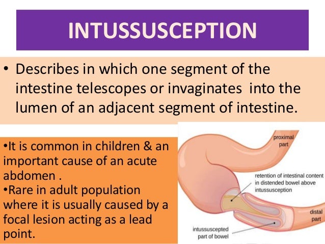 Intussusception in Adults-Submucosal Lipoma at Transverse colon-A ra…