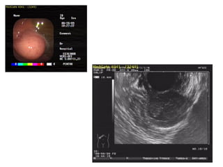 Subepithelial lesions | PPT