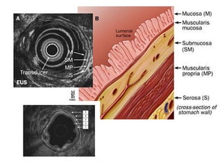 Subepithelial lesions | PPT