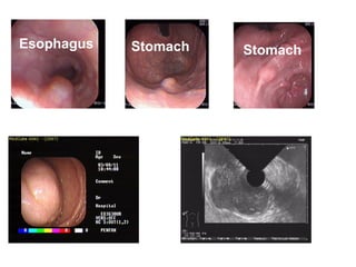Subepithelial lesions | PPT