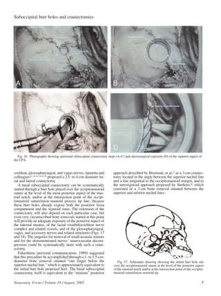 Suboccipital bur holes and craniectomies | PDF