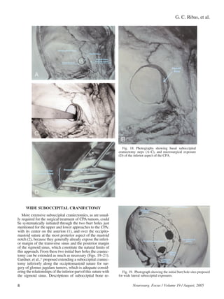 Suboccipital bur holes and craniectomies | PDF