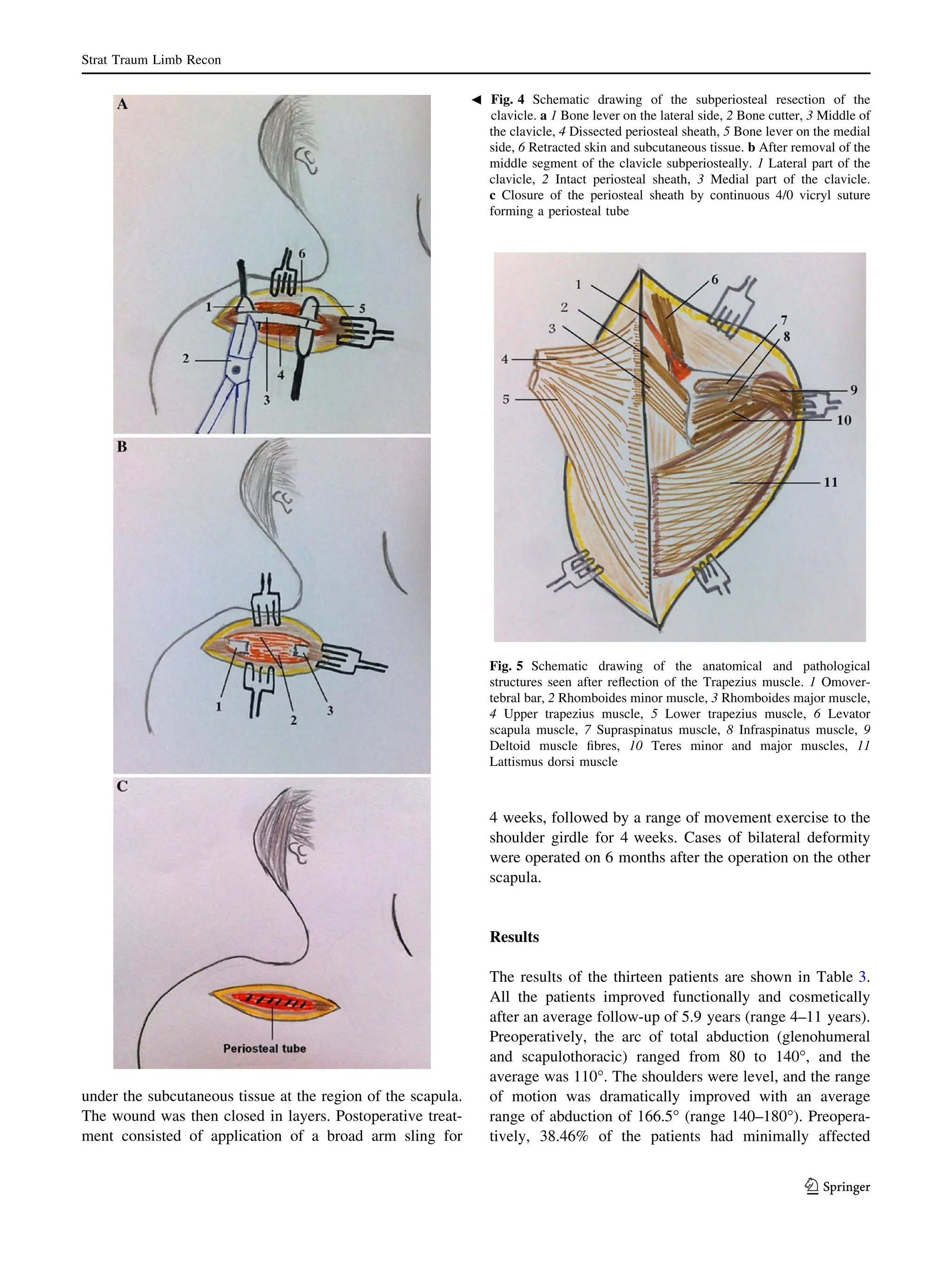 Subperiosteal resection of mid-clavicle in sprengel's.pdf