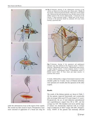 Subperiosteal resection of mid-clavicle in sprengel's.pdf