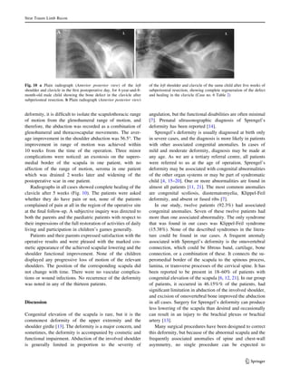 Subperiosteal resection of mid-clavicle in sprengel's.pdf