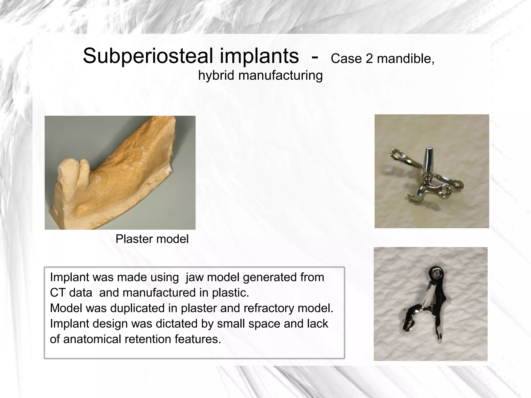 Introduction to subperiosteal implants | ODP