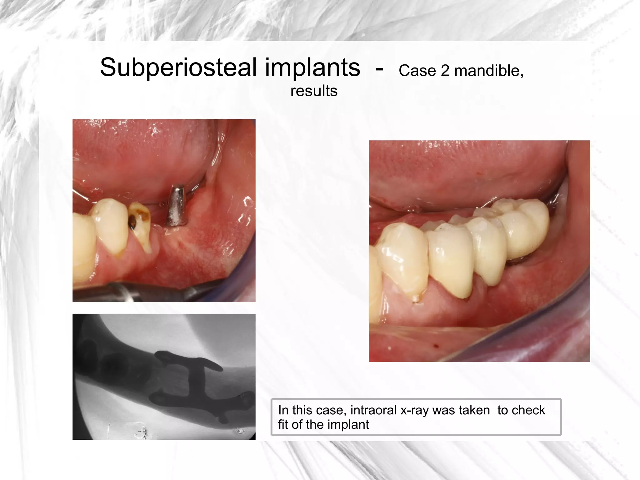 Introduction to subperiosteal implants | ODP